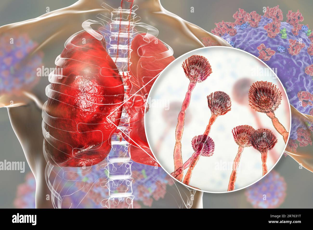Pulmonary aspergillosis, invasion of a lung tissue by mold fungi Aspergillus with close-up view ...