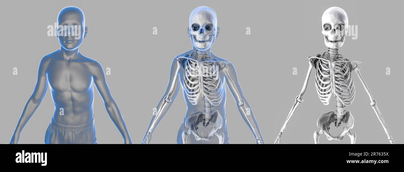 Scoliosis in children, computer illustration. A child with curved spine ...