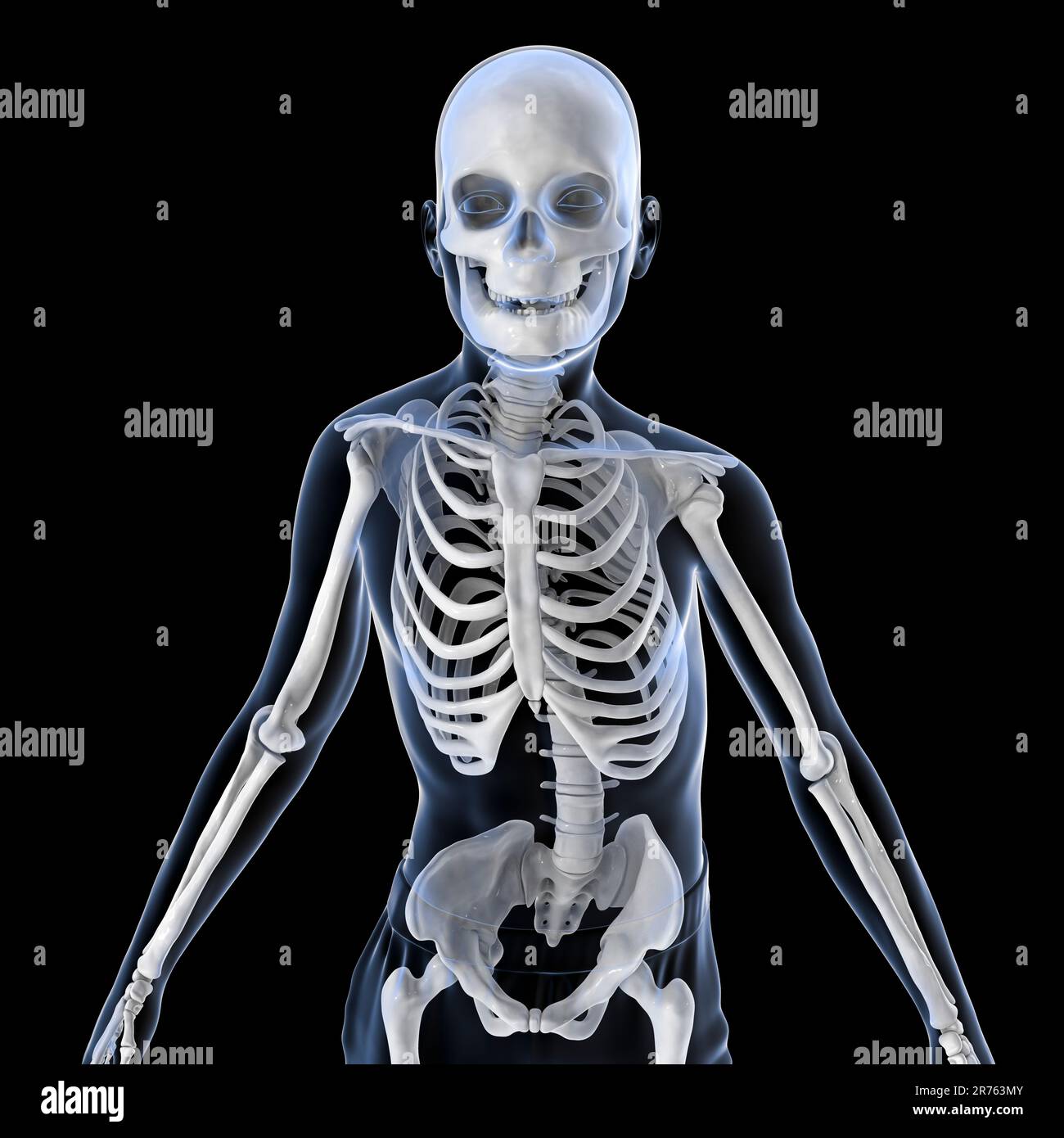 Scoliosis in children, computer illustration. A child with highlighted ...