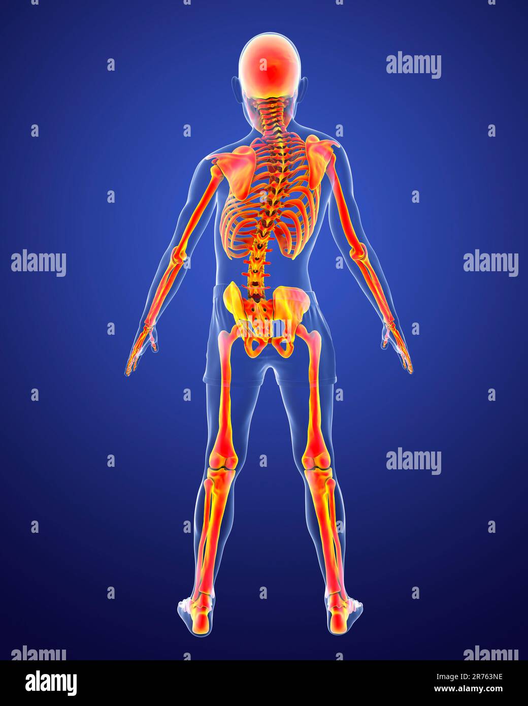 Scoliosis in children, computer illustration. A child with highlighted ...