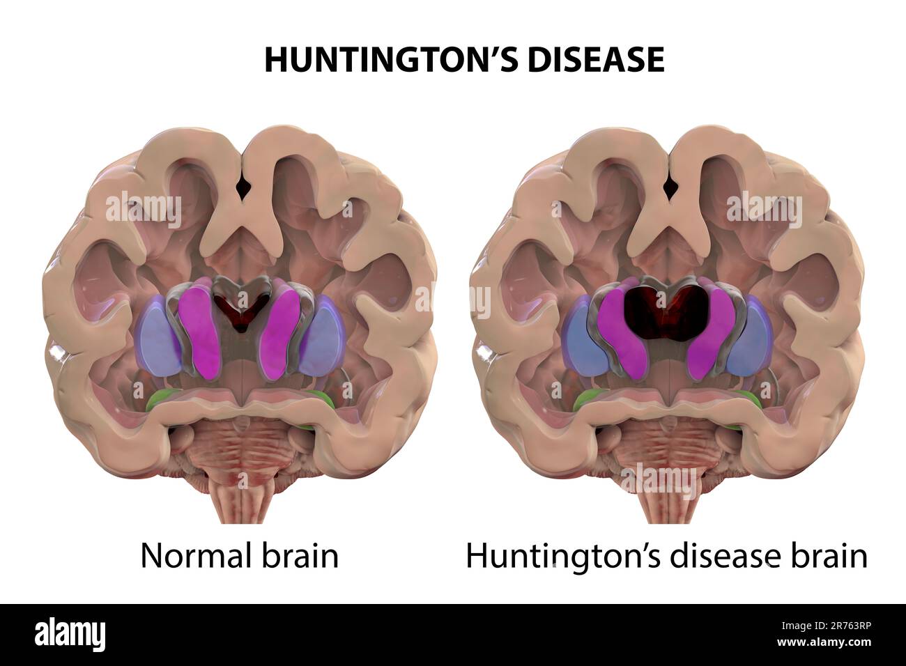 Dorsal striatum and lateral ventricles in healthy brain and in ...