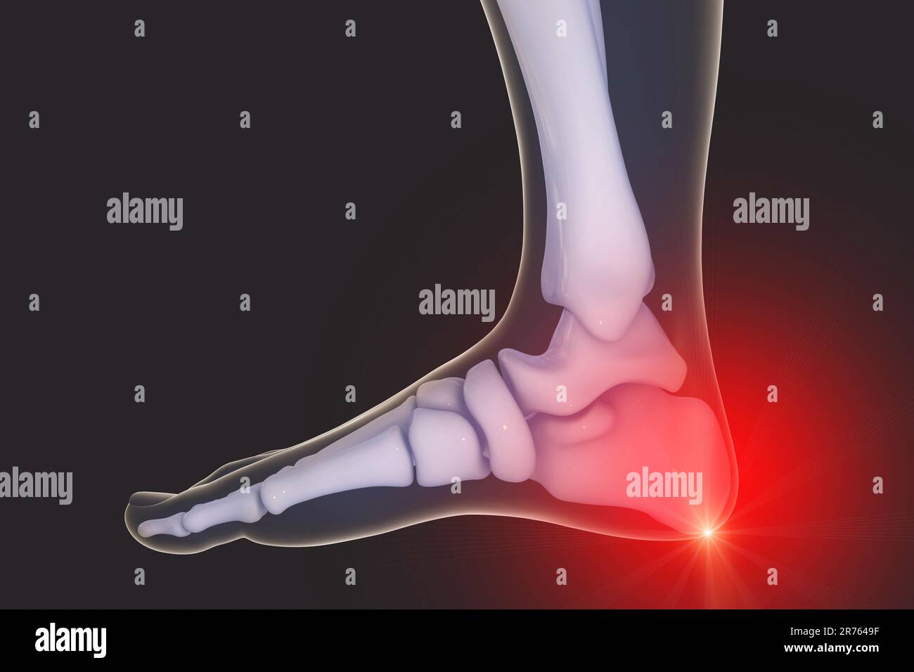 Heel spur illustration hi-res stock photography and images - Alamy