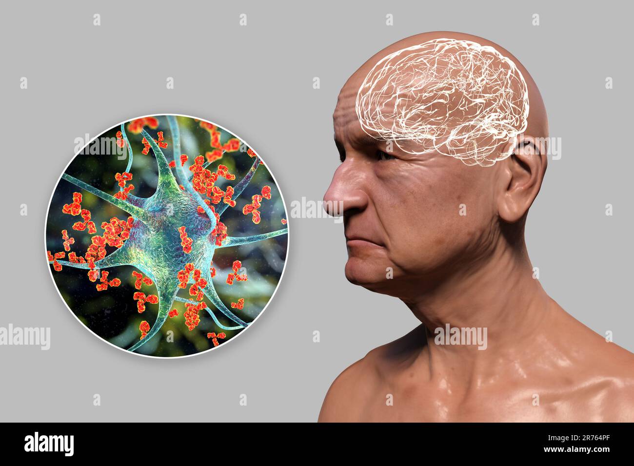 Anti-neuronal antibodies in neuredegenerative diseases and dementia ...
