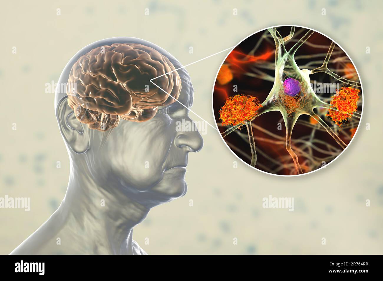 Dementia, conceptual computer illustration showing an elderly person ...