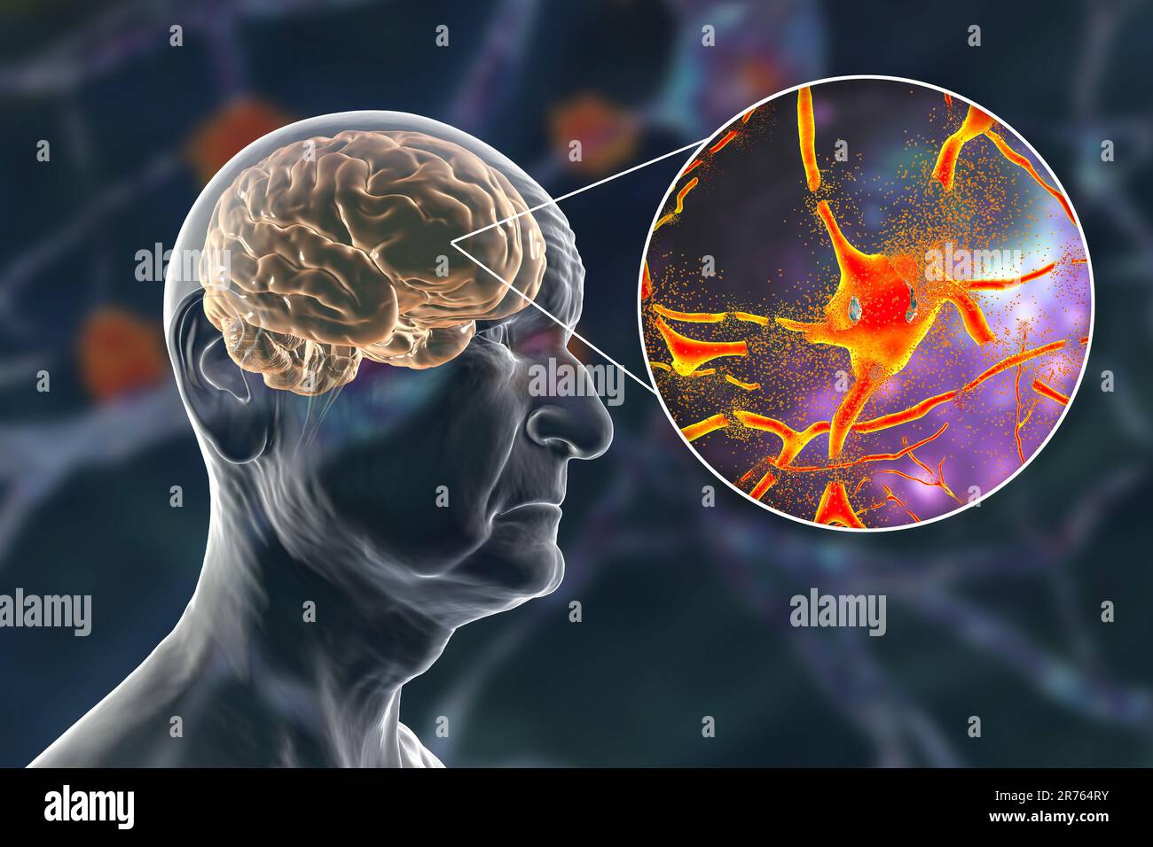 Dementia and Alzheimer's disease, conceptual computer illustration ...