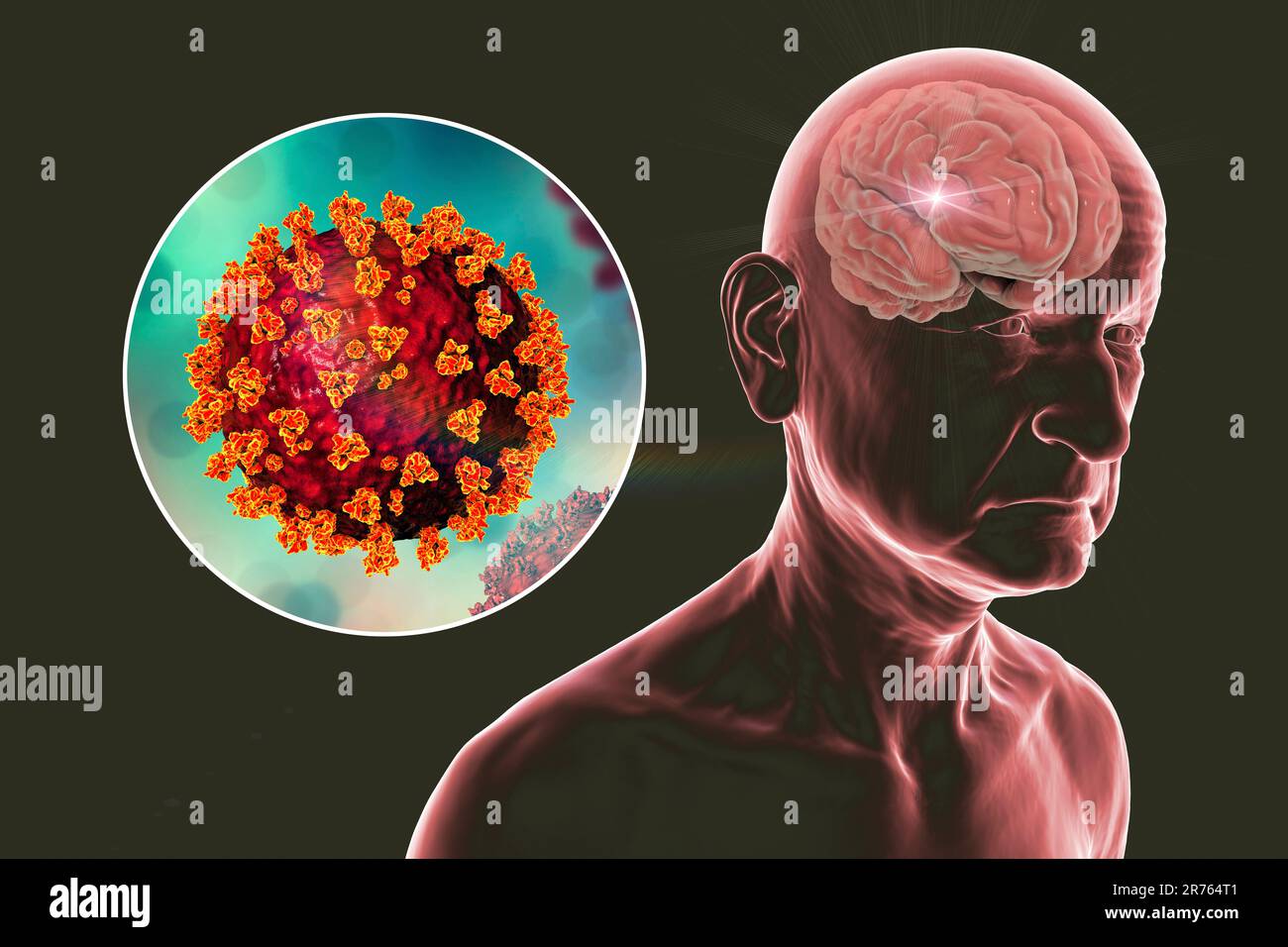 Covid-19 and dementia. Neuropsychiatric sequelae of Covid-19 ...
