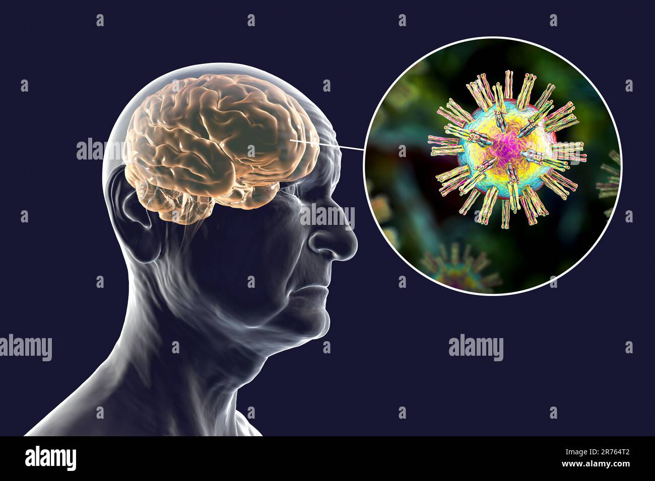 Herpes viruses in the role of dementia. Conceptual 3D illustration ...