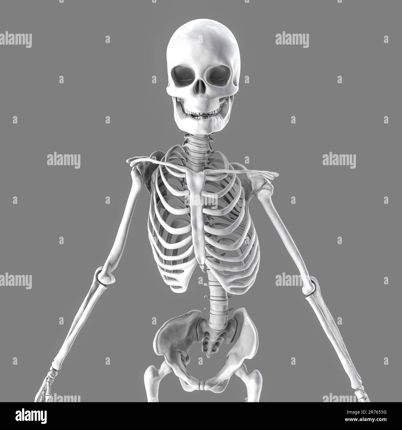 Scoliosis in children, computer illustration. A child skeleton with ...