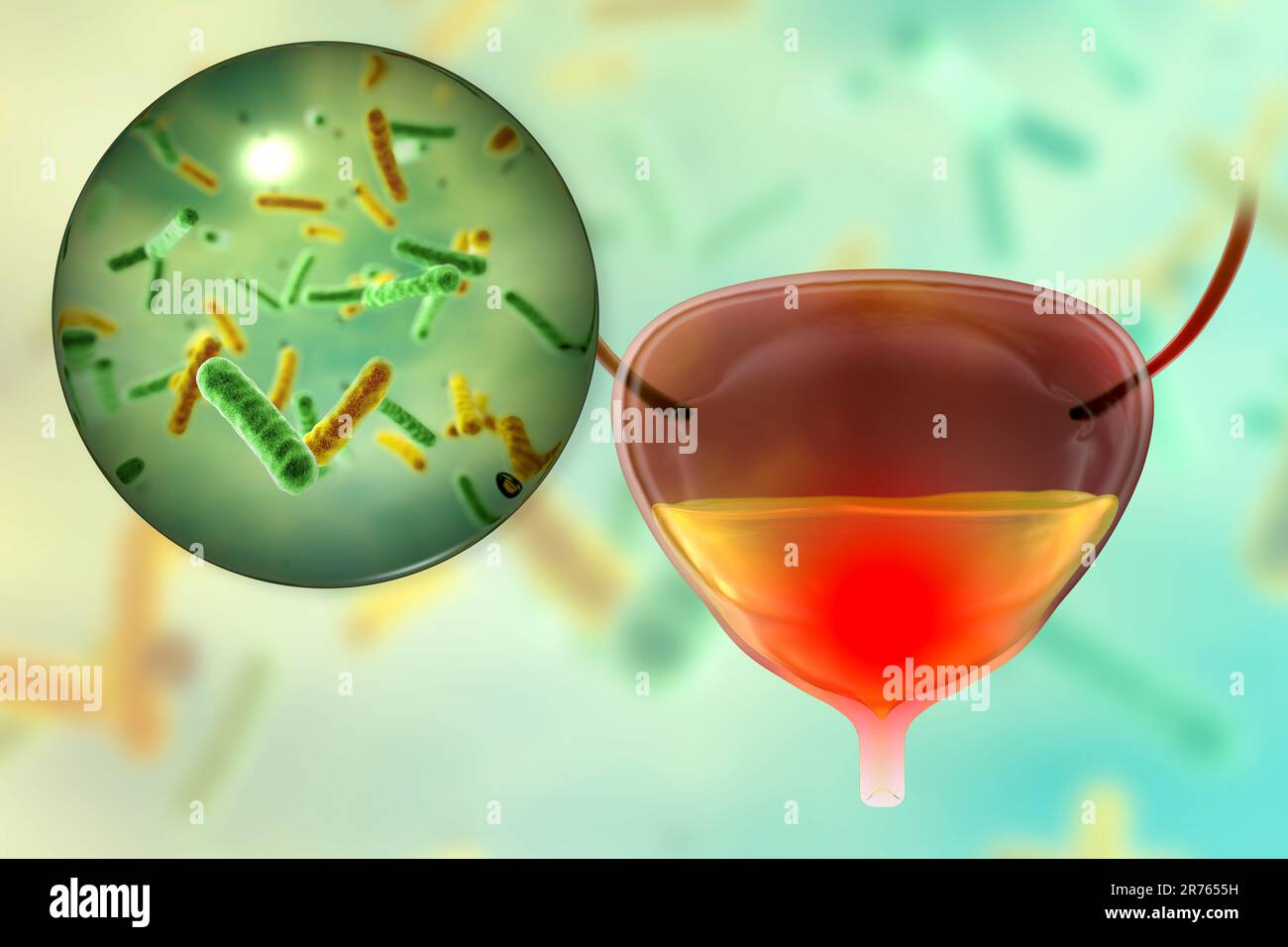 Cystitis, bacterial infection of urinary bladder, conceptual computer ...