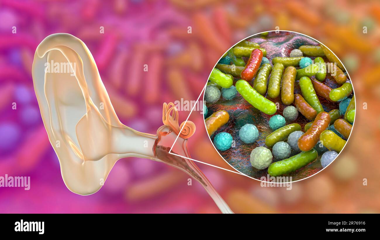 Otitis media ear infection and closeup view of bacteria, the ...