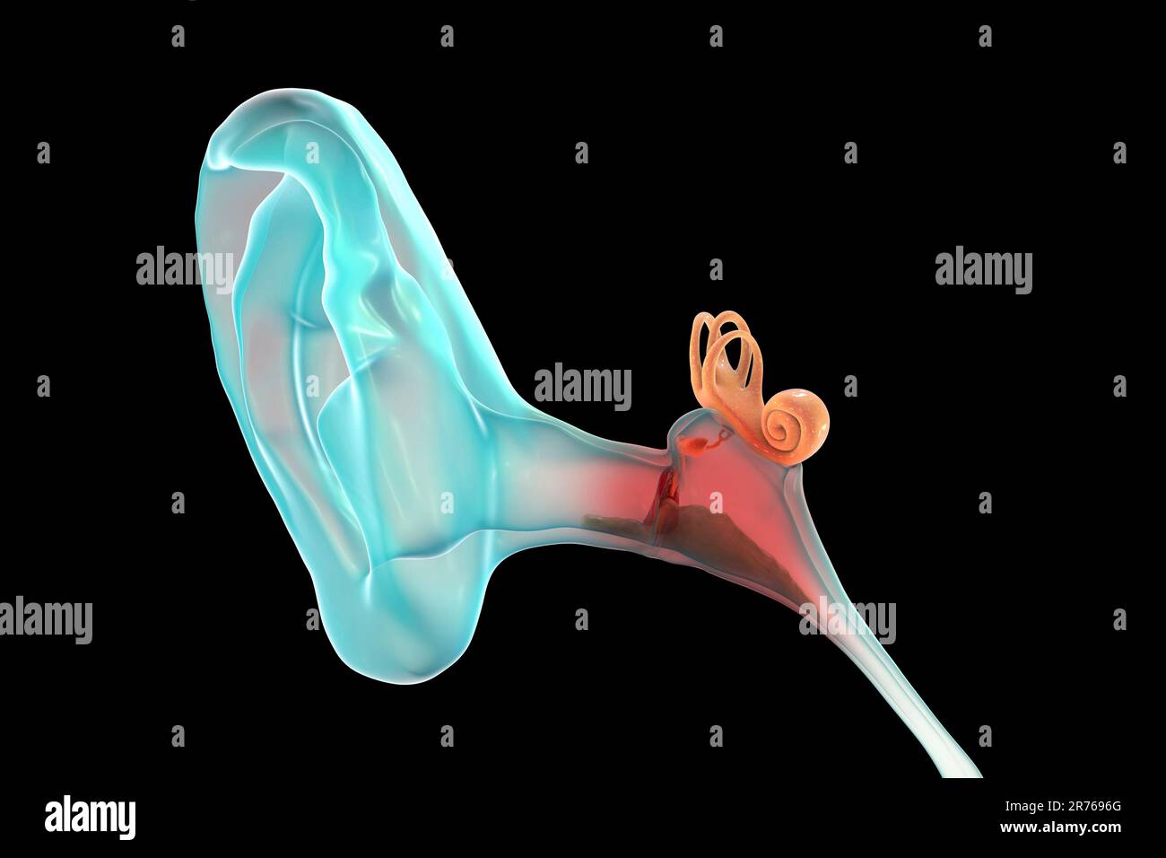 Otitis media ear infection, computer illustration Stock Photo - Alamy