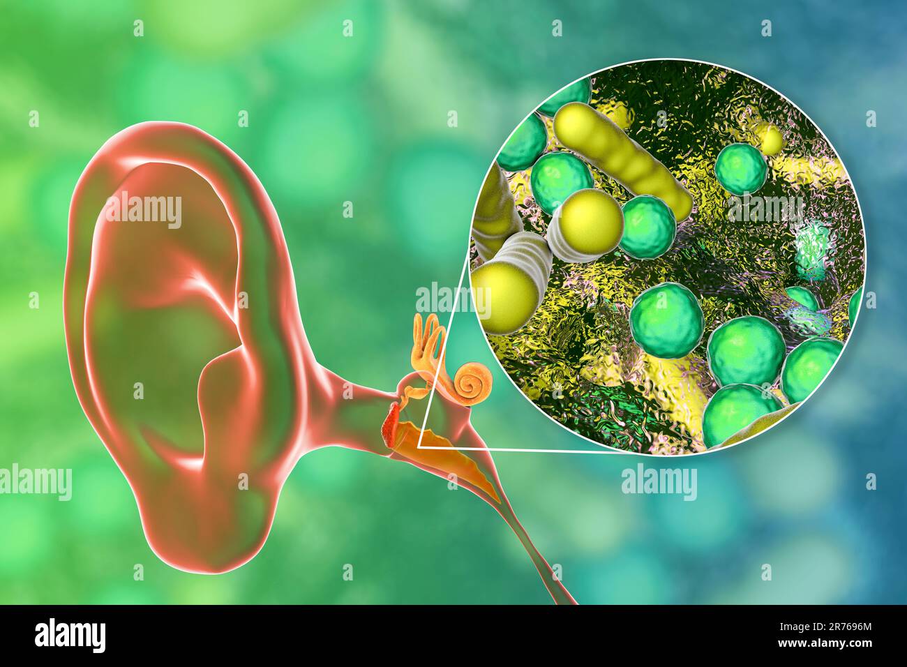 Otitis Media Ear Infection And Closeup View Of Bacteria The Etiological Agents Of The Middle
