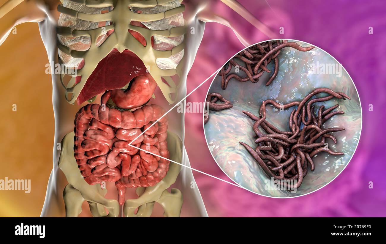 Round worms in human intestine, computer artwork. Roundworms, or ...