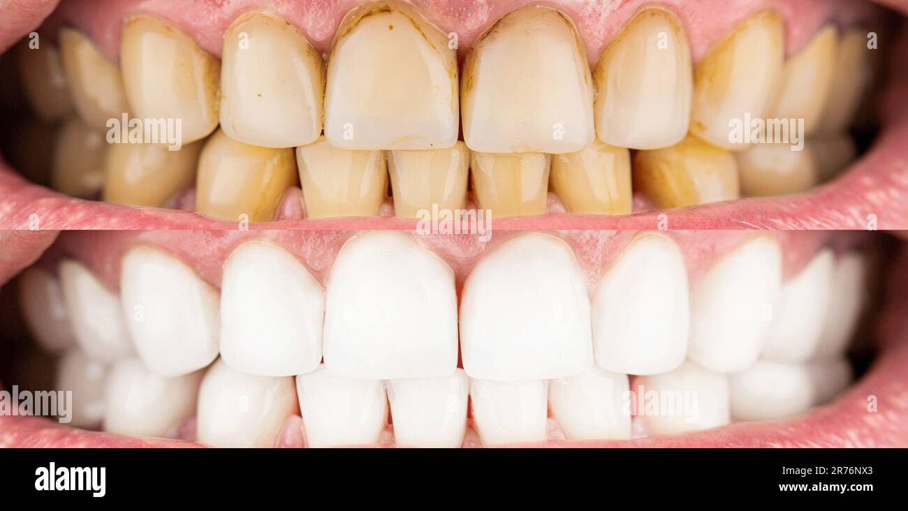 Close-up man Teeth Before And After Whitening. Male teeth before and ...