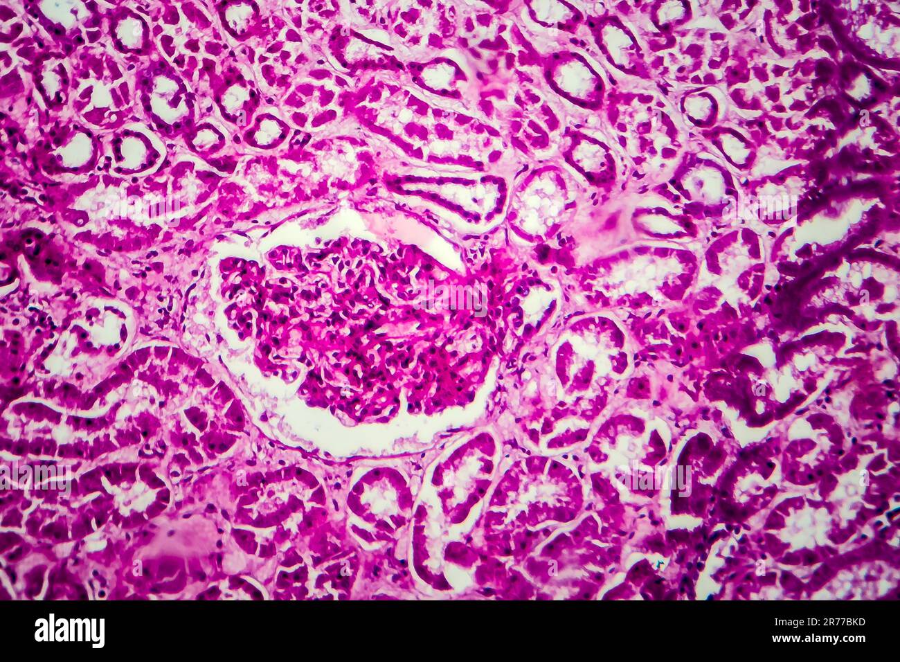 Glomerulonephritis. Light micrograph of tissue from a kidney in a case ...