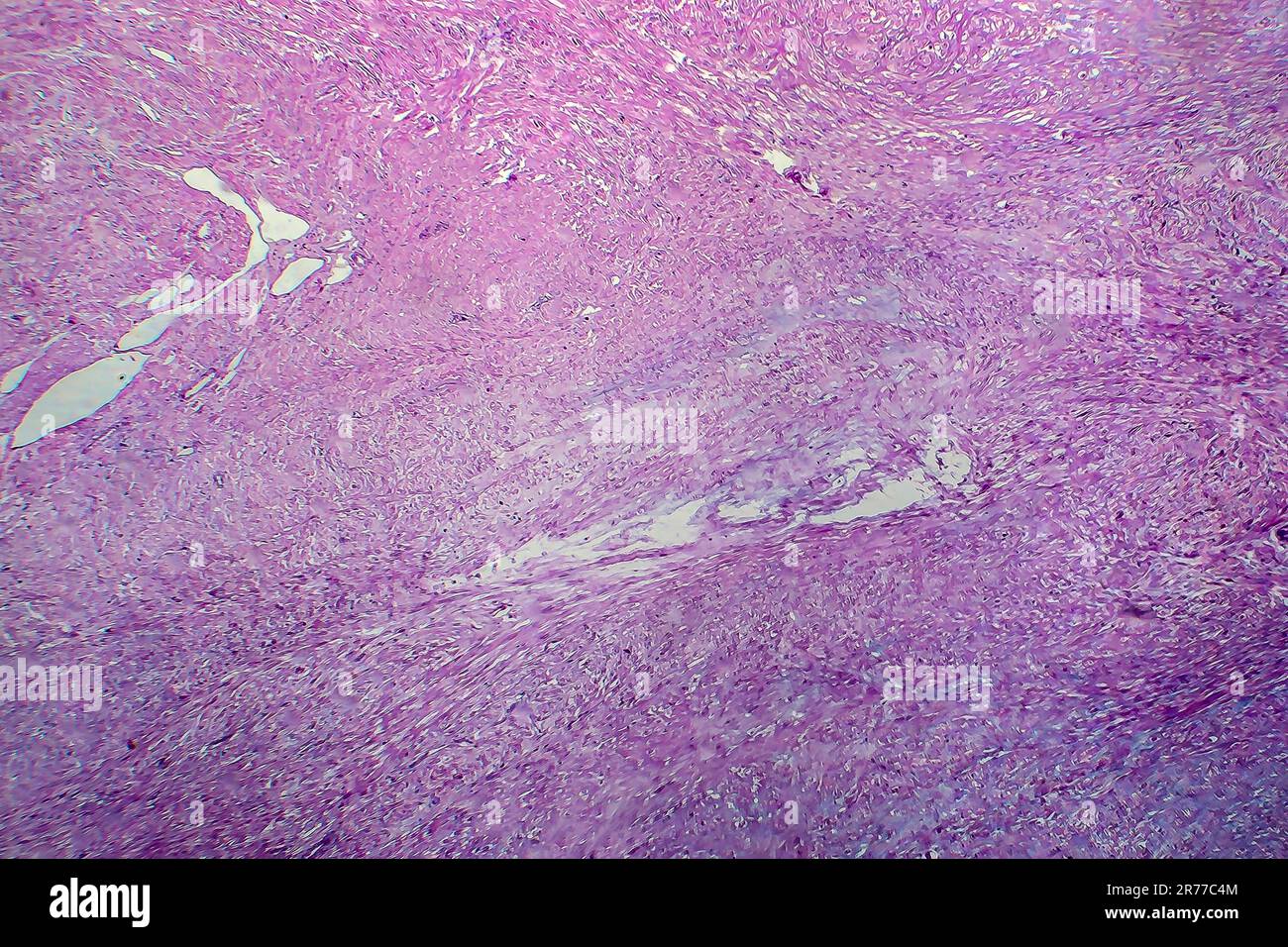 Uterine fibroid. Light micrograph (LM) of a section through tissue from ...