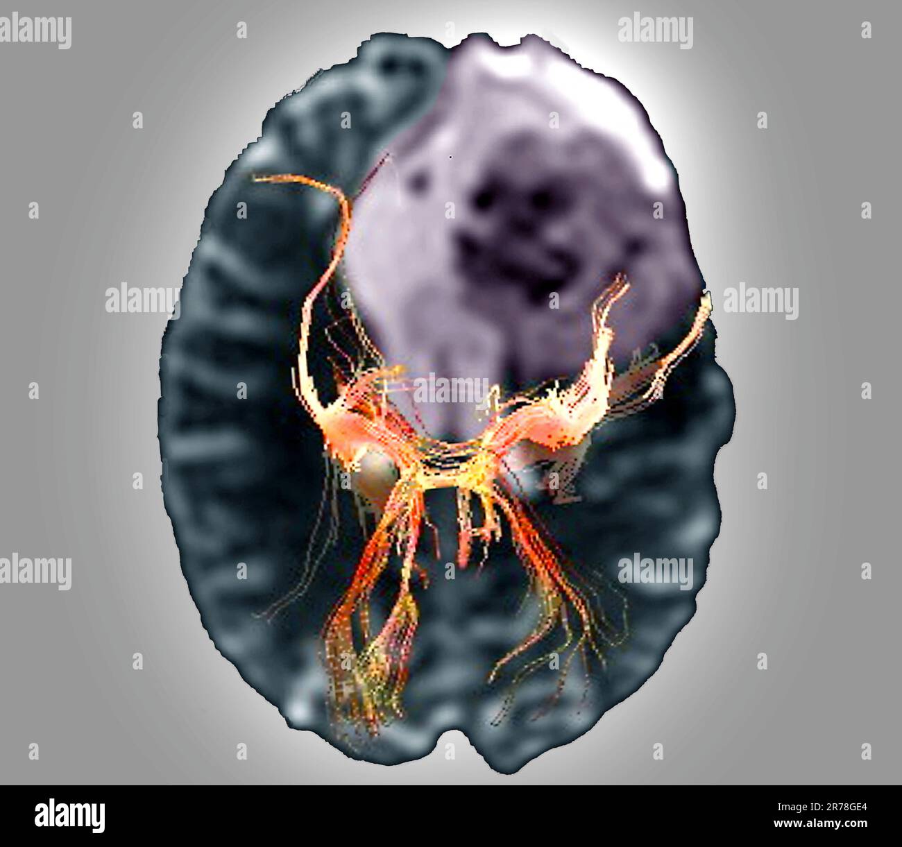 Coloured diffusion tensor imaging (DTI) magnetic resonance imaging (MRI) scan of nerve pathways ...