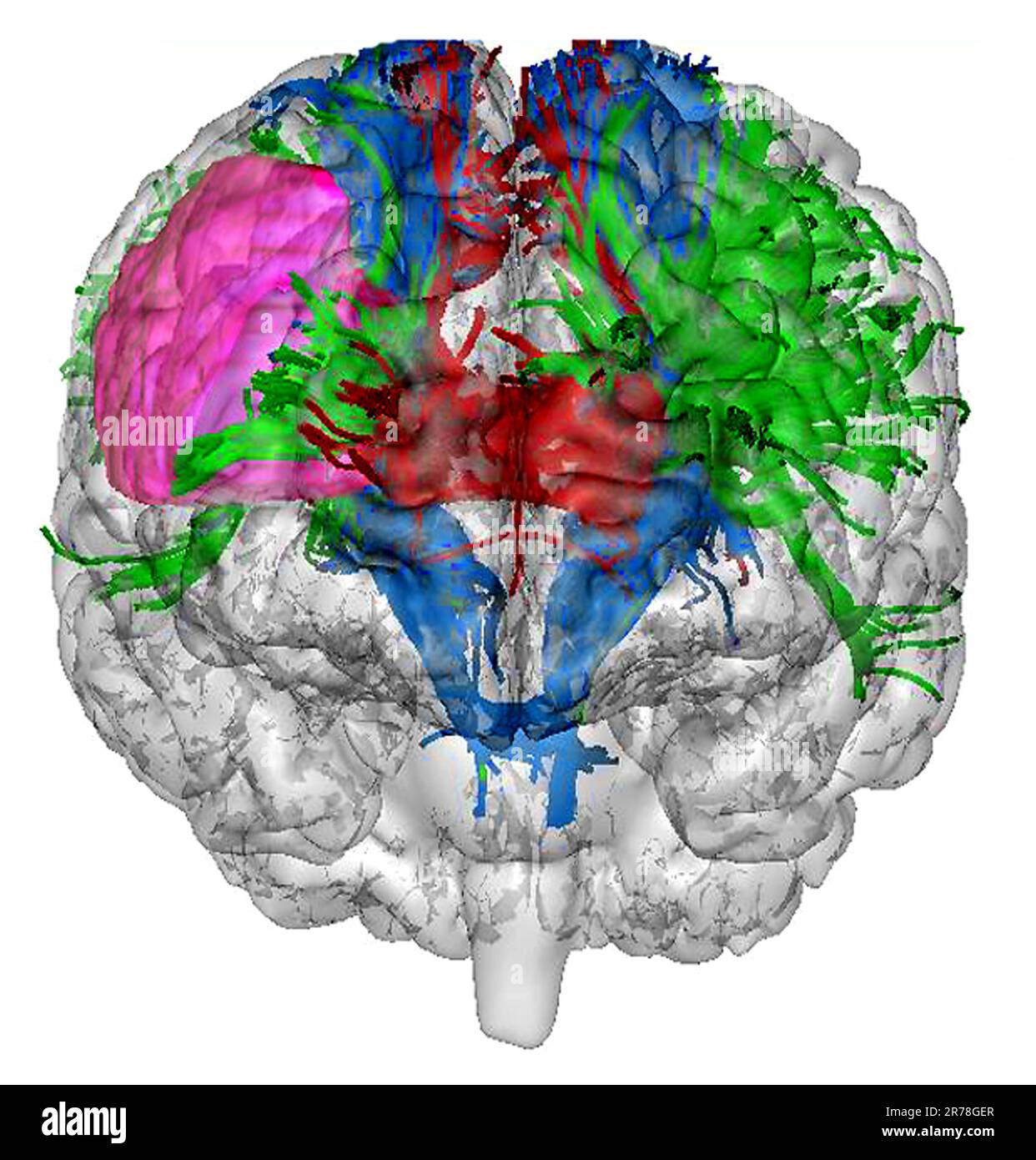 Coloured 3D diffusion tensor imaging (DTI) magnetic resonance imaging (MRI) scan of nerve ...