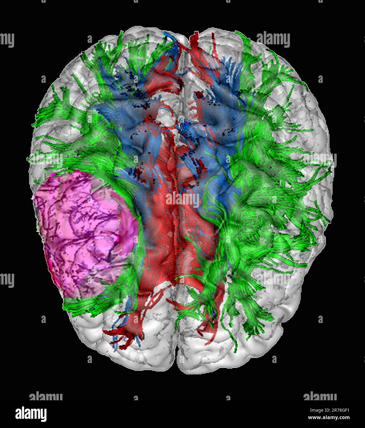 Coloured 3D diffusion tensor imaging (DTI) magnetic resonance imaging (MRI) scan of nerve ...