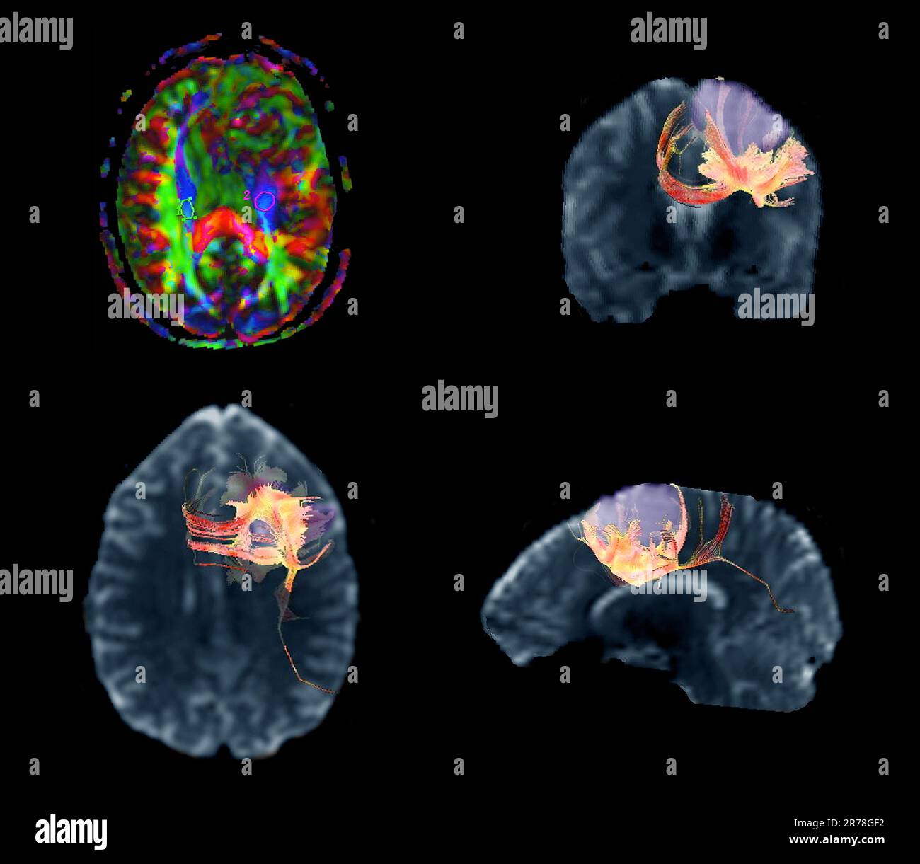 Coloured diffusion tensor imaging (DTI) magnetic resonance imaging (MRI) scans of nerve pathways ...