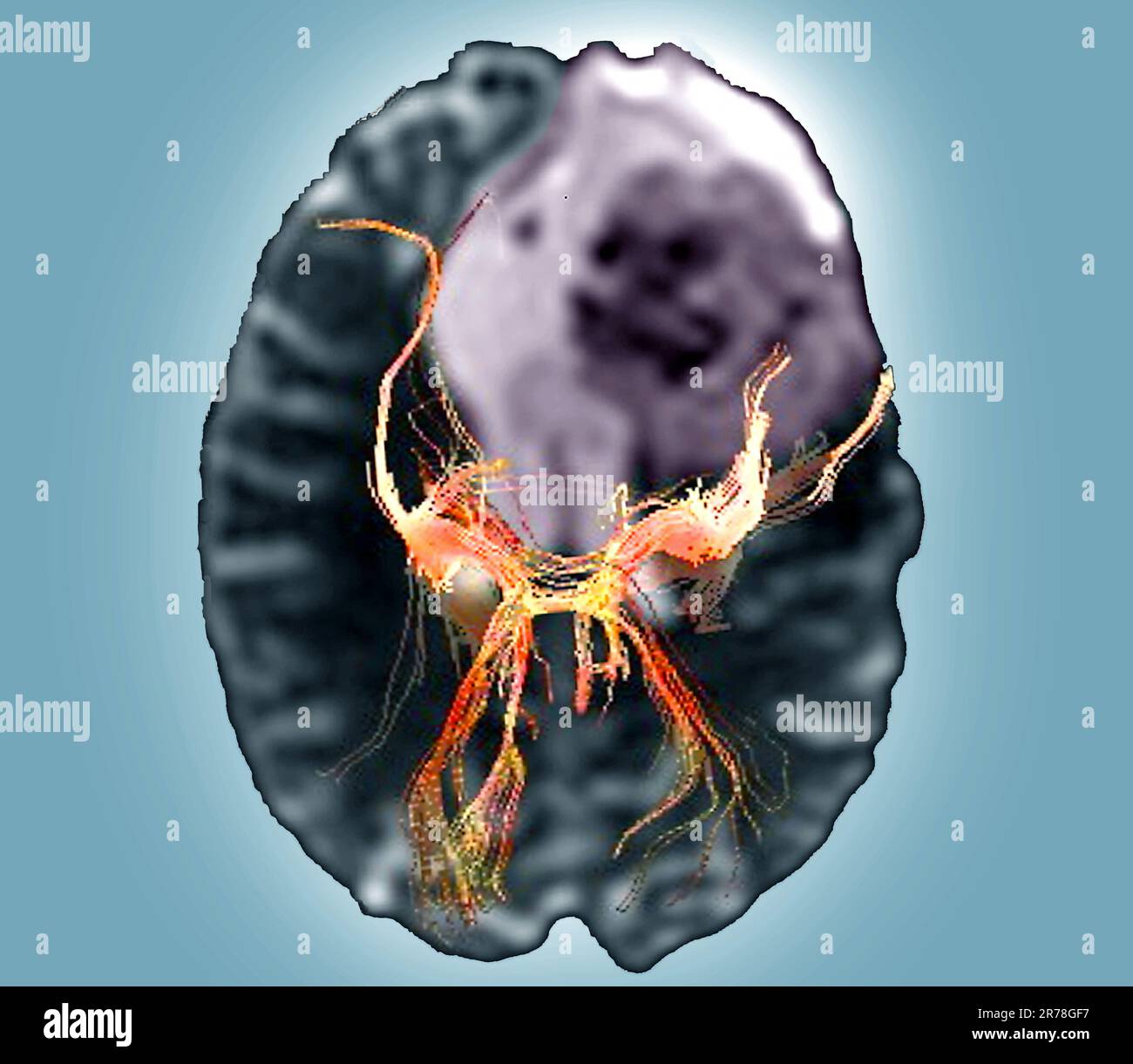 Coloured diffusion tensor imaging (DTI) magnetic resonance imaging (MRI) scan of nerve pathways ...