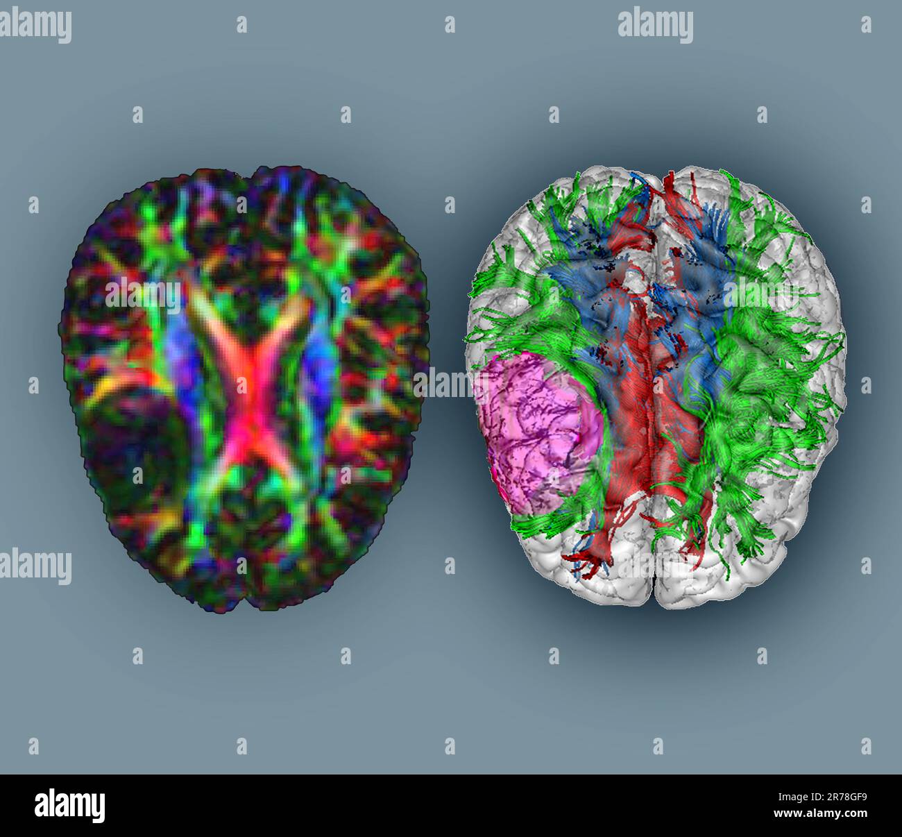 Coloured 2D (left) and 3D (right) diffusion tensor imaging (DTI) magnetic resonance imaging (MRI ...