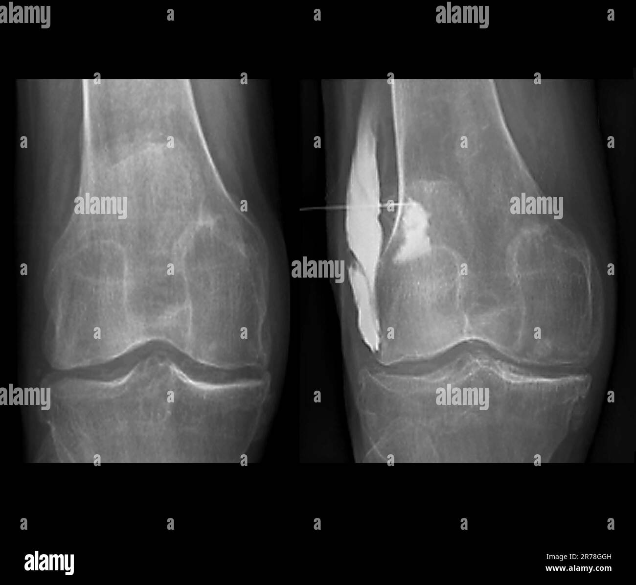 X-rays of the knee joint of a 59 year old male patient undergoing ...