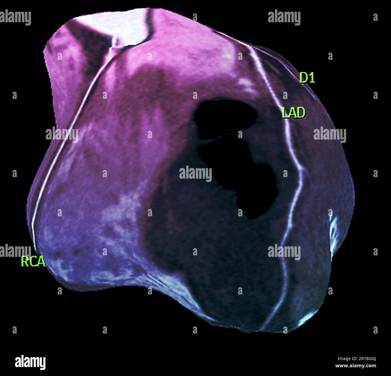 Coloured 3D computed tomography (CT) angiogram scan of the heart of a 58 year old male patient ...