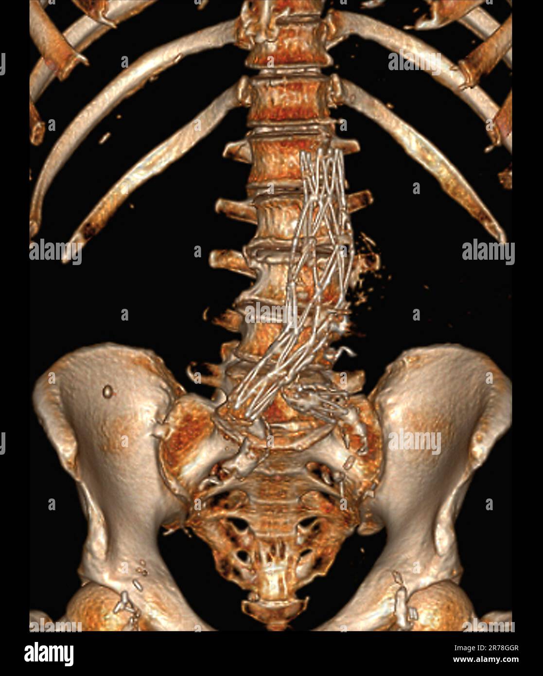 Coloured 3D computed tomography (CT) angiogram scan of the abdomen of a 70 year old male patient ...