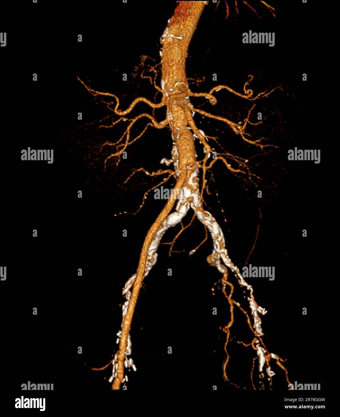 Coloured 3D computed tomography (CT) angiogram scan showing ...