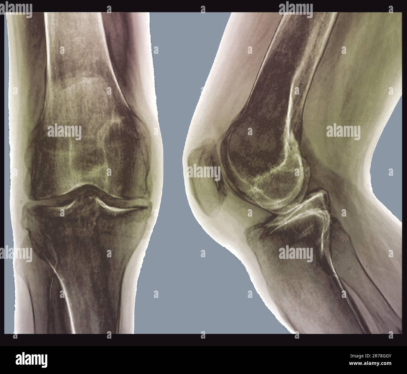 Coloured X-rays of the knee joint of a 59 year old male patient ...