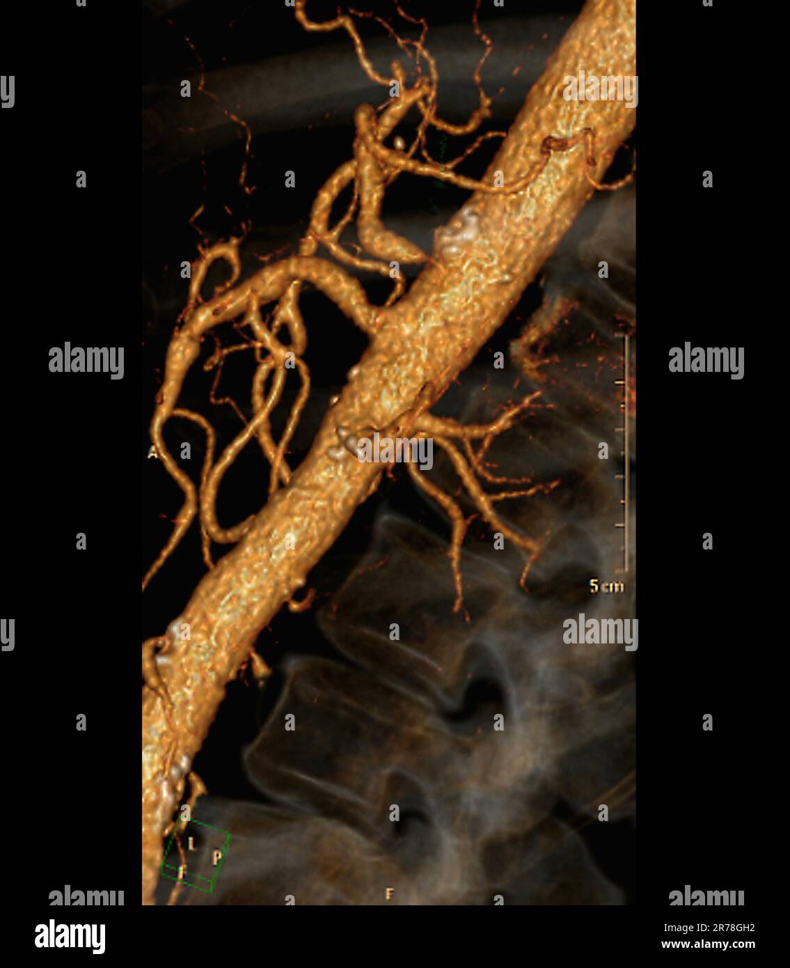 Coloured 3D computed tomography (CT) angiogram scan of the aorta of a 61 year old male patient ...