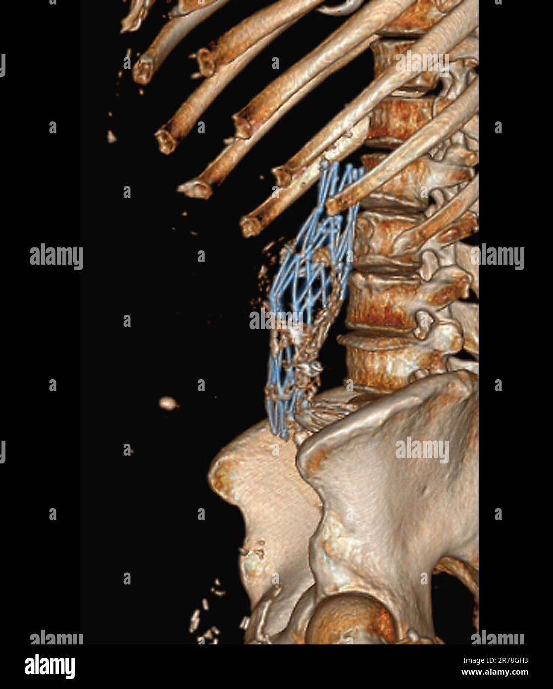 Coloured 3D computed tomography (CT) angiogram scan of the abdomen of a ...