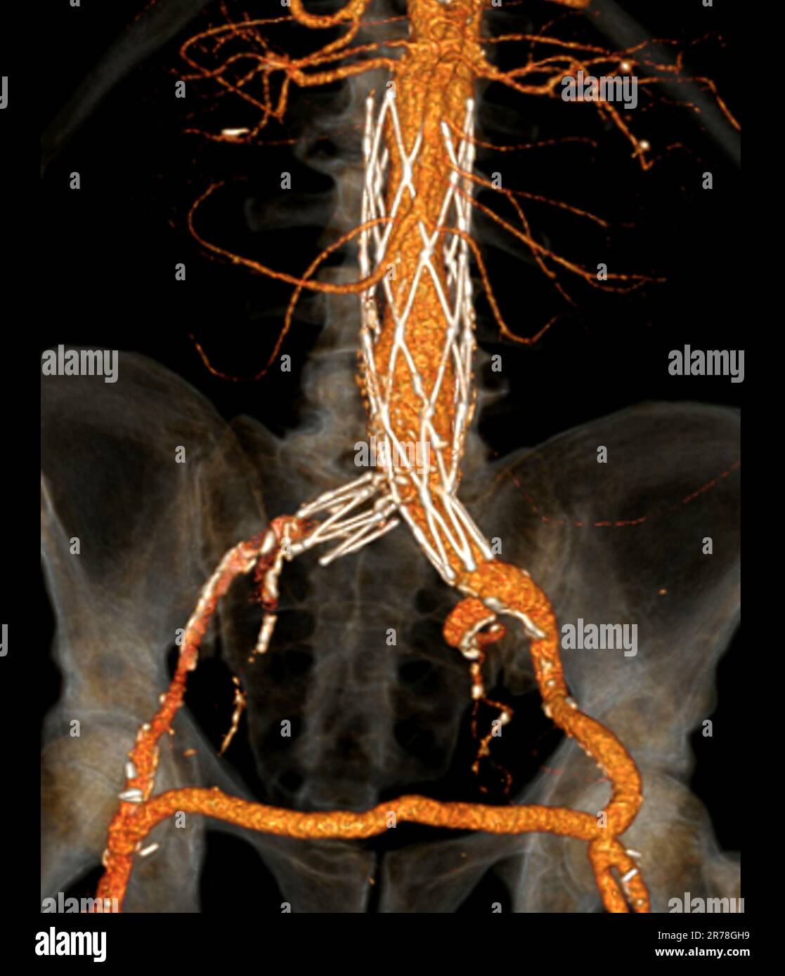 Coloured 3D computed tomography (CT) angiogram scan of the abdomen of a ...