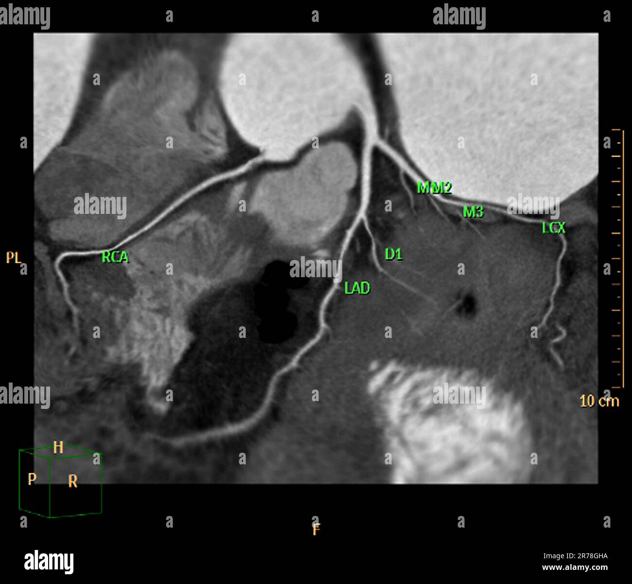 3D computed tomography (CT) angiogram scan of the heart of a 58 year ...