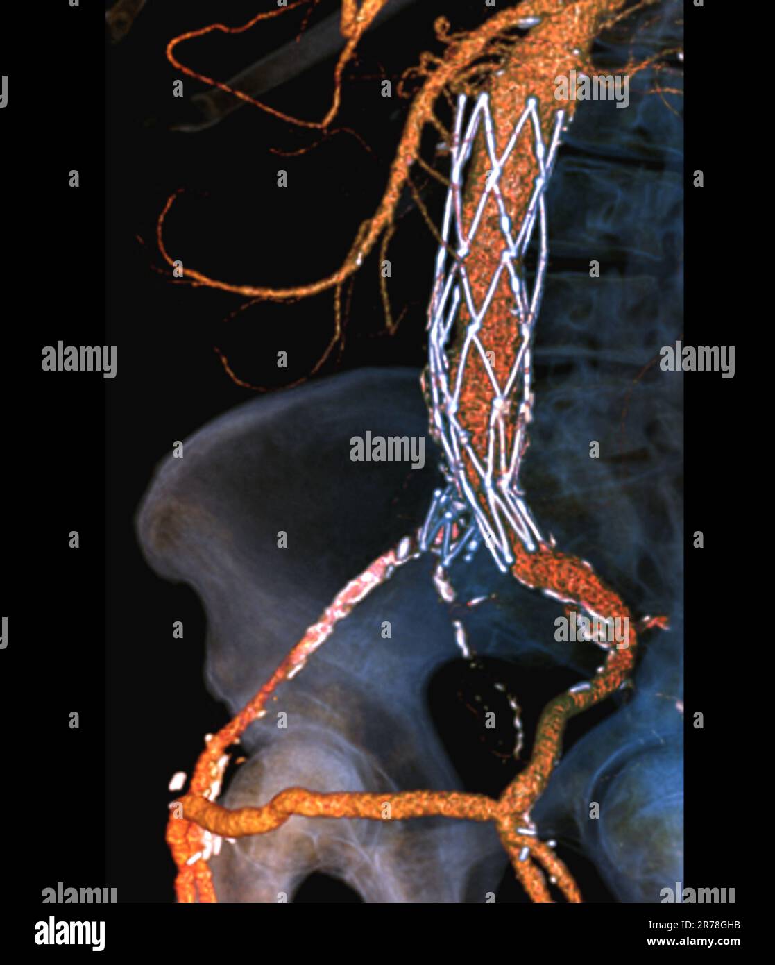 Coloured 3D computed tomography (CT) angiogram scan of the abdomen of a 75 year old male patient ...