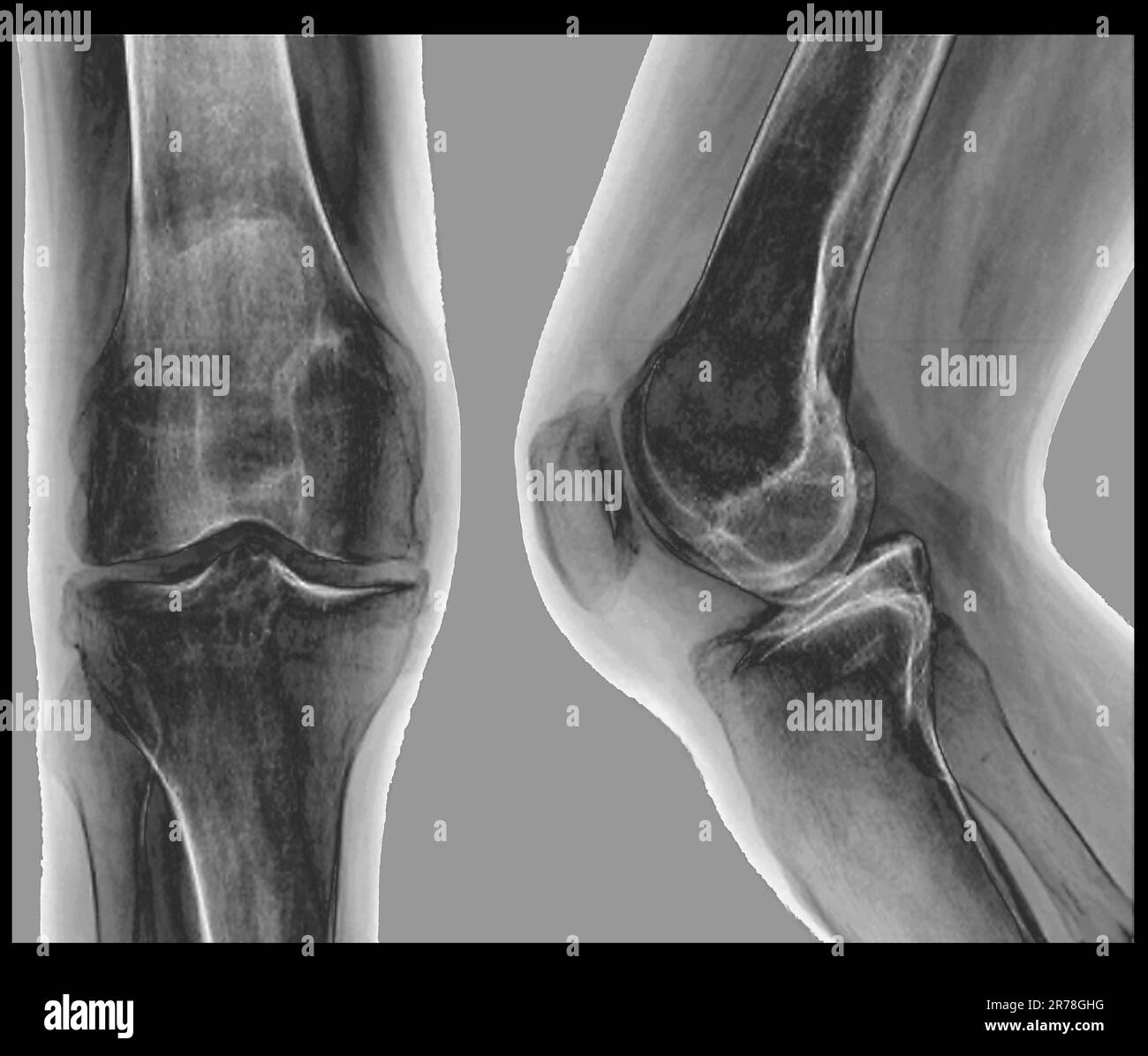 Chondrocalcinosis X Ray