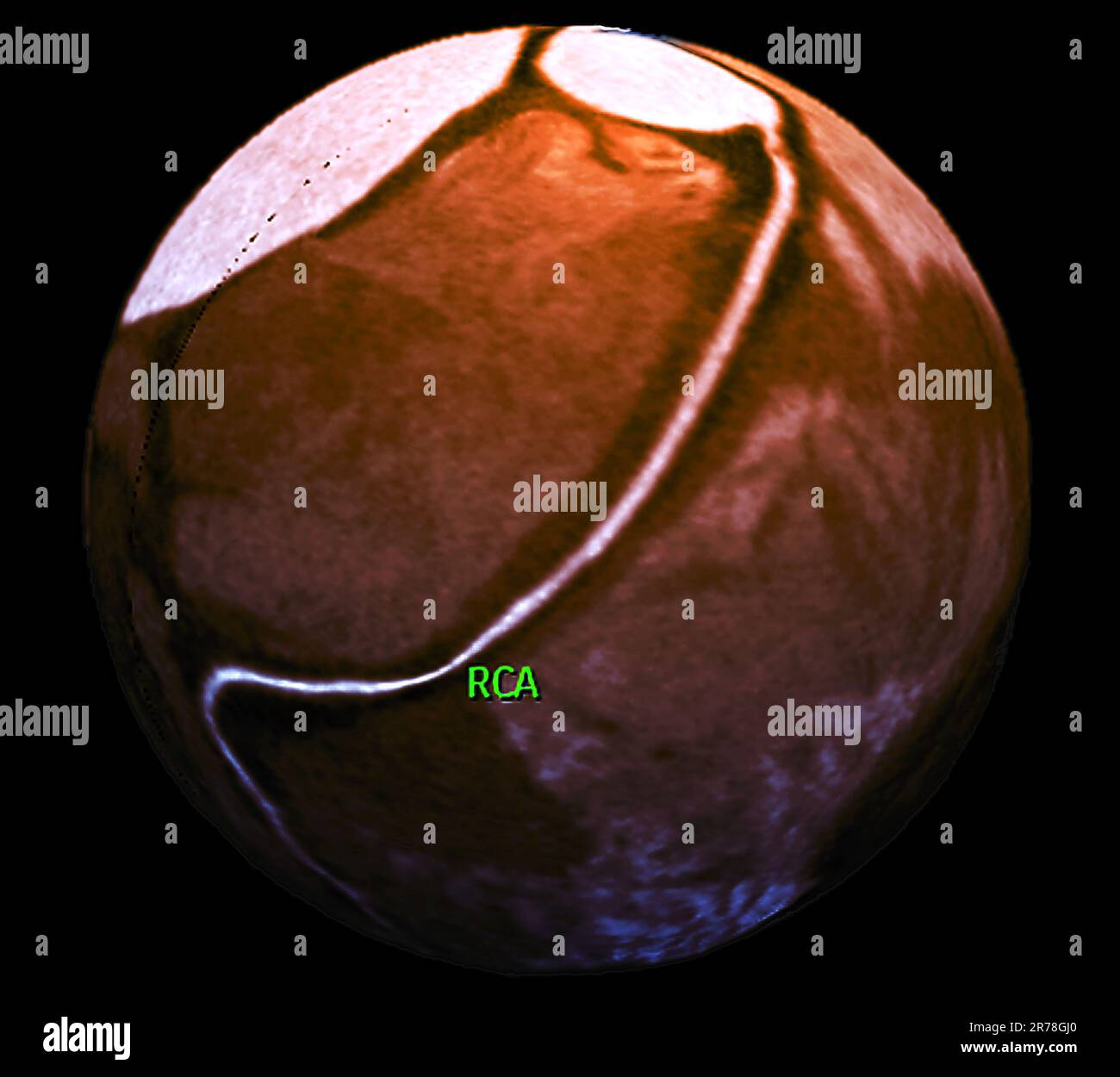Coloured 3D computed tomography (CT) angiogram scan of the heart of a ...