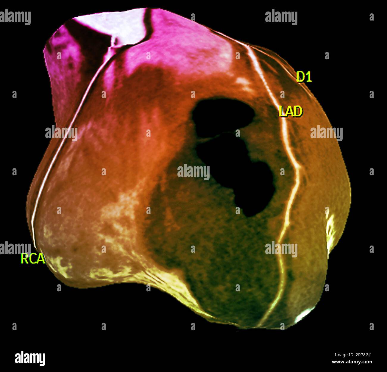Coloured 3D computed tomography (CT) angiogram scan of the heart of a 58 year old male patient ...