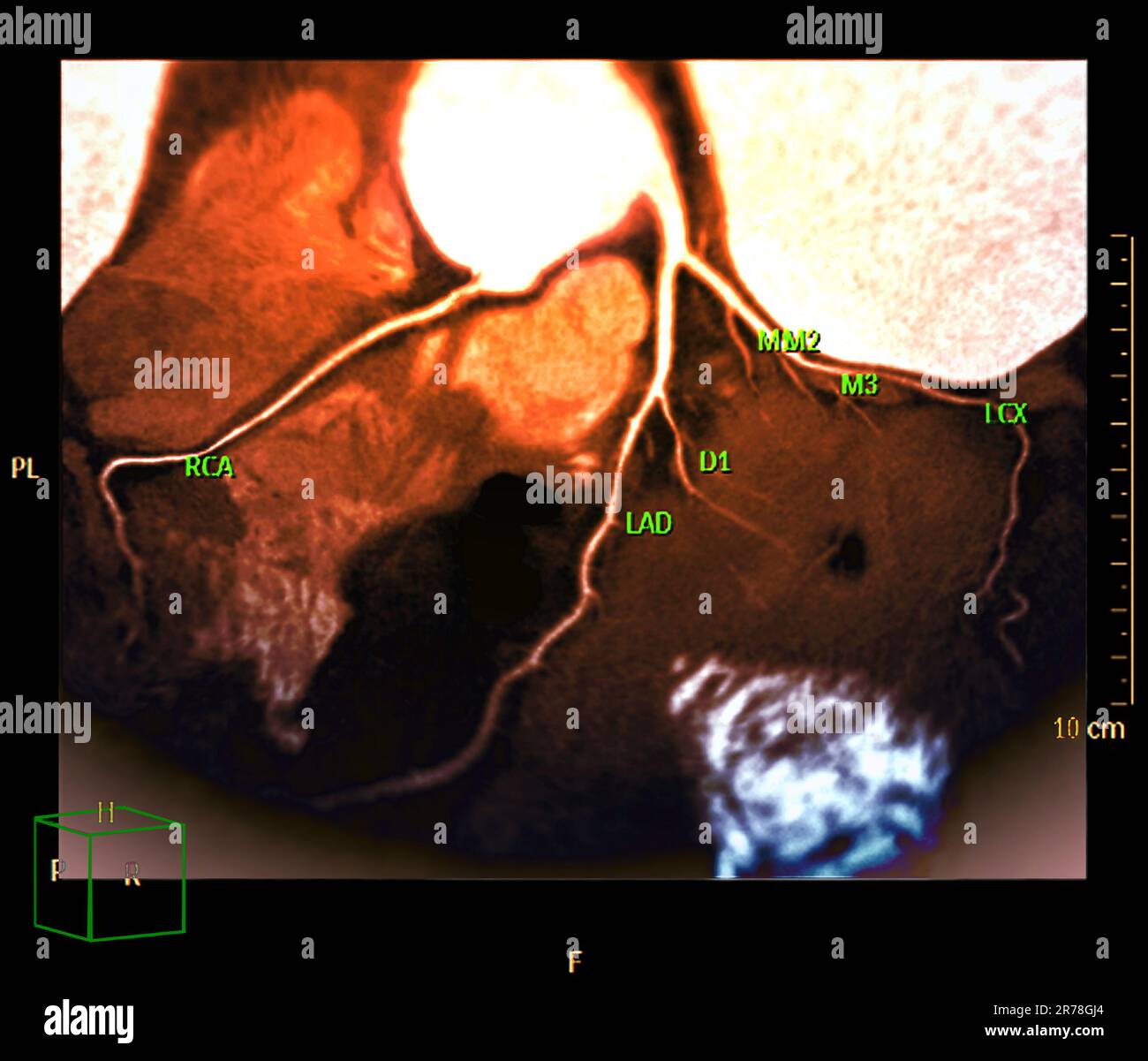 Coloured 3D computed tomography (CT) angiogram scan of the heart of a 58 year old male patient ...