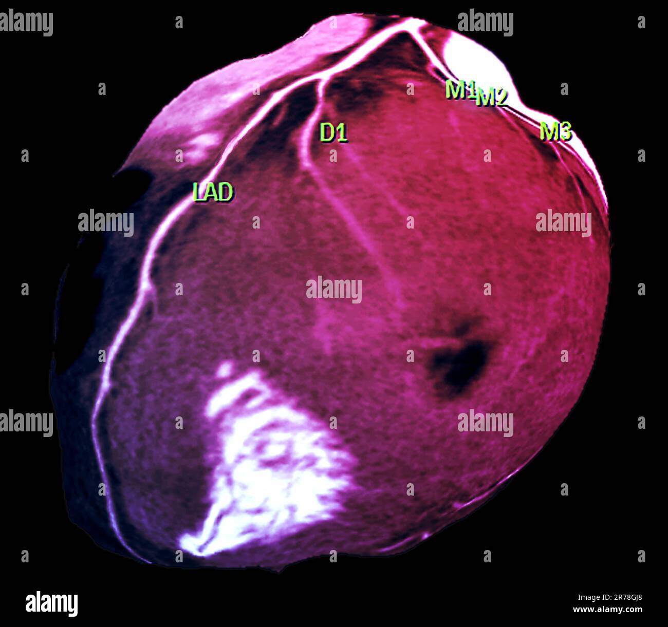 Coloured 3D computed tomography (CT) angiogram scan of the heart of a ...