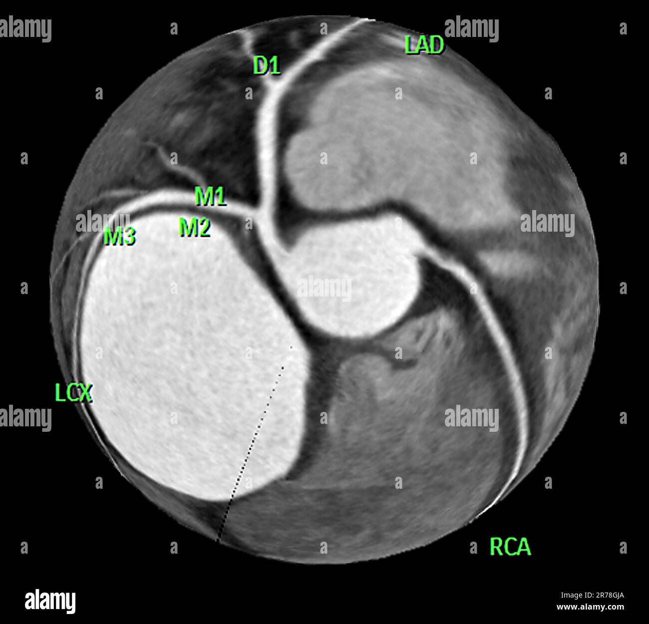 3D computed tomography (CT) angiogram scan of the heart of a 58 year ...