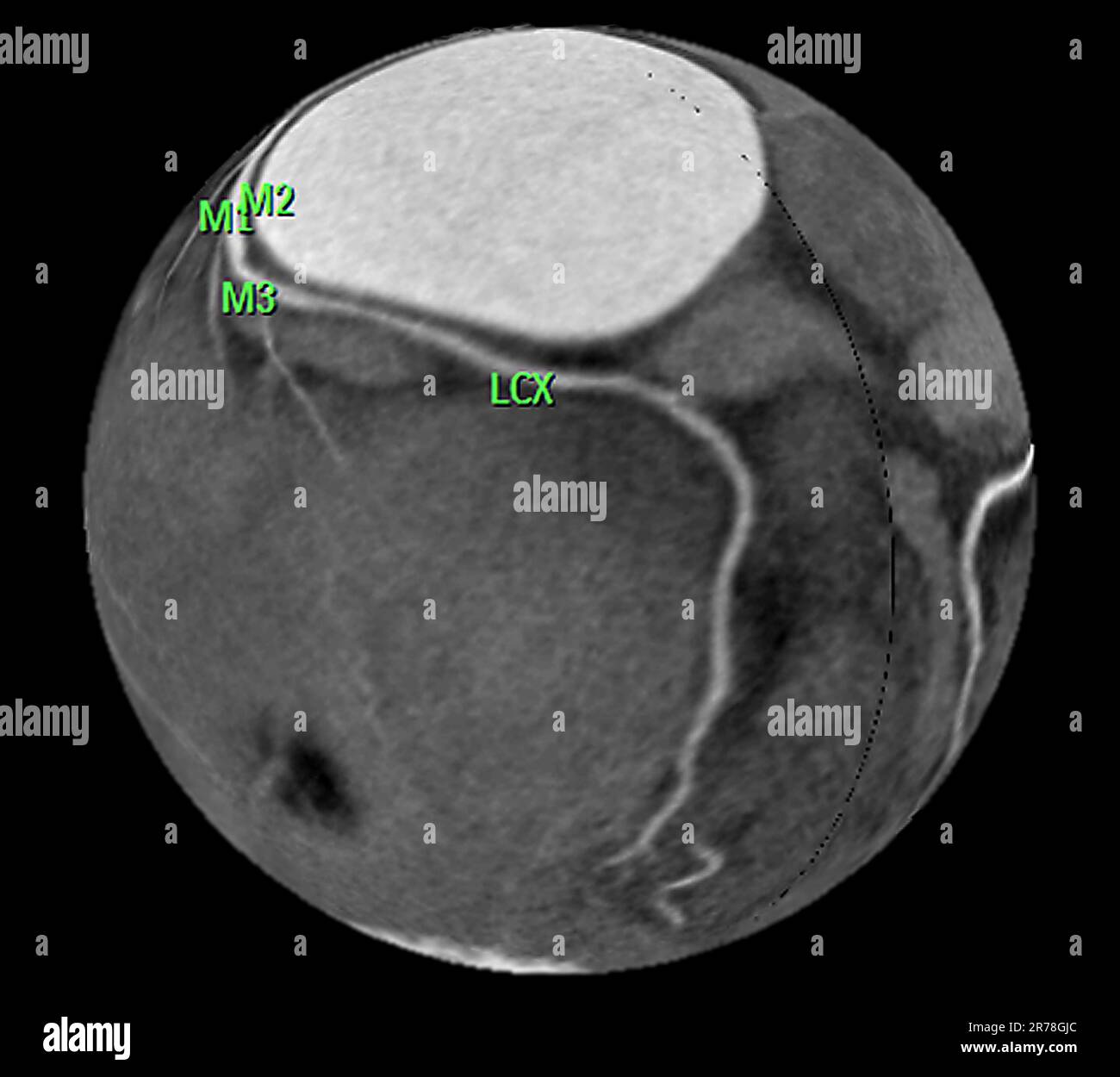 3D computed tomography (CT) angiogram scan of the heart of a 58 year ...