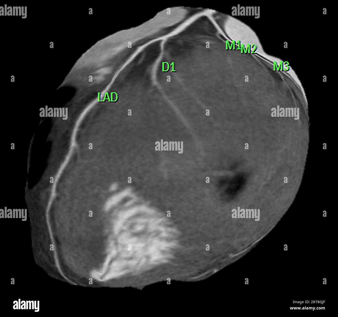3D computed tomography (CT) angiogram scan of the heart of a 58 year ...