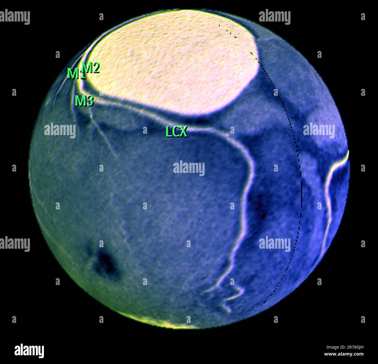 Coloured 3D computed tomography (CT) angiogram scan of the heart of a ...
