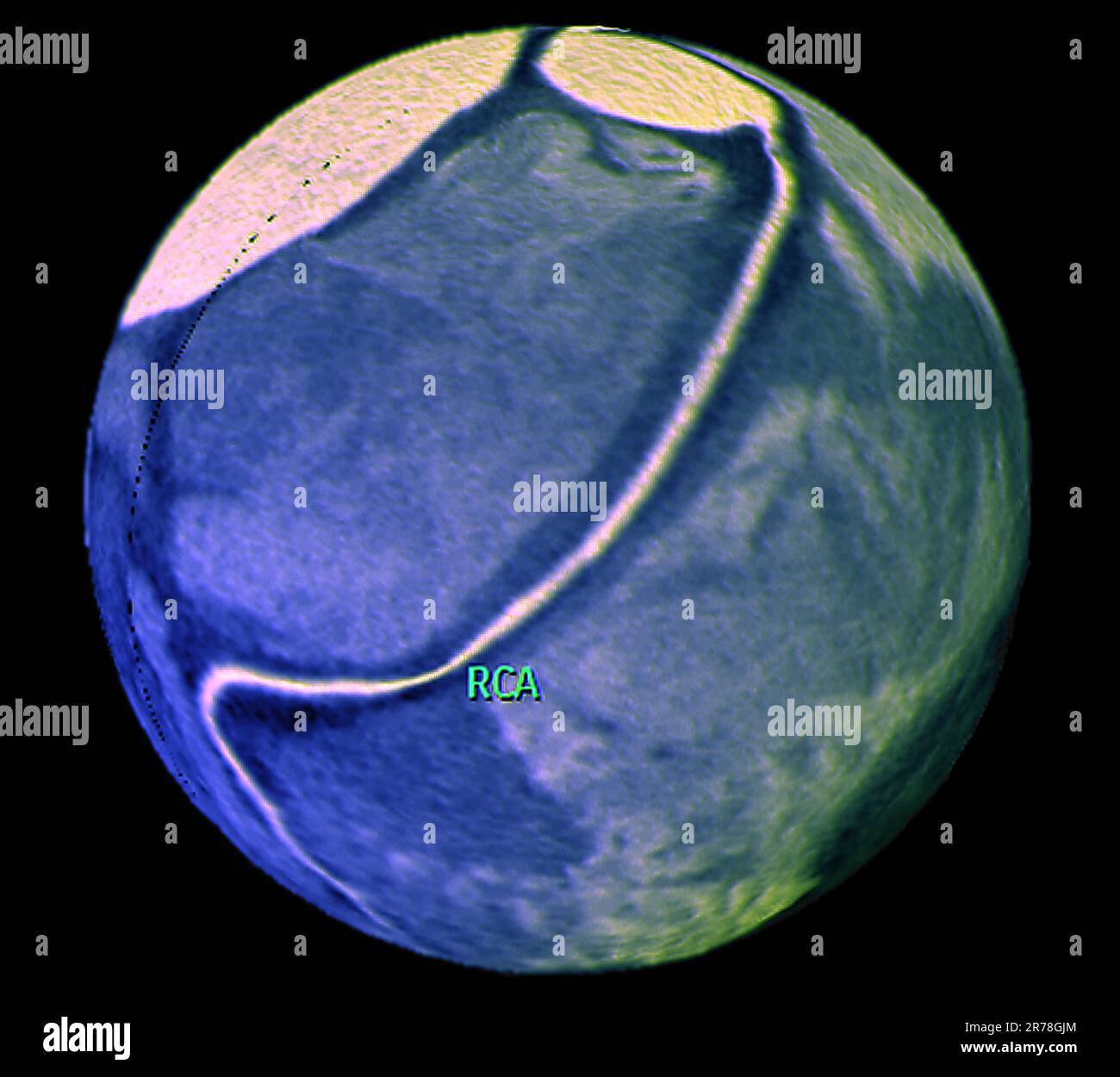 Coloured 3D computed tomography (CT) angiogram scan of the heart of a ...