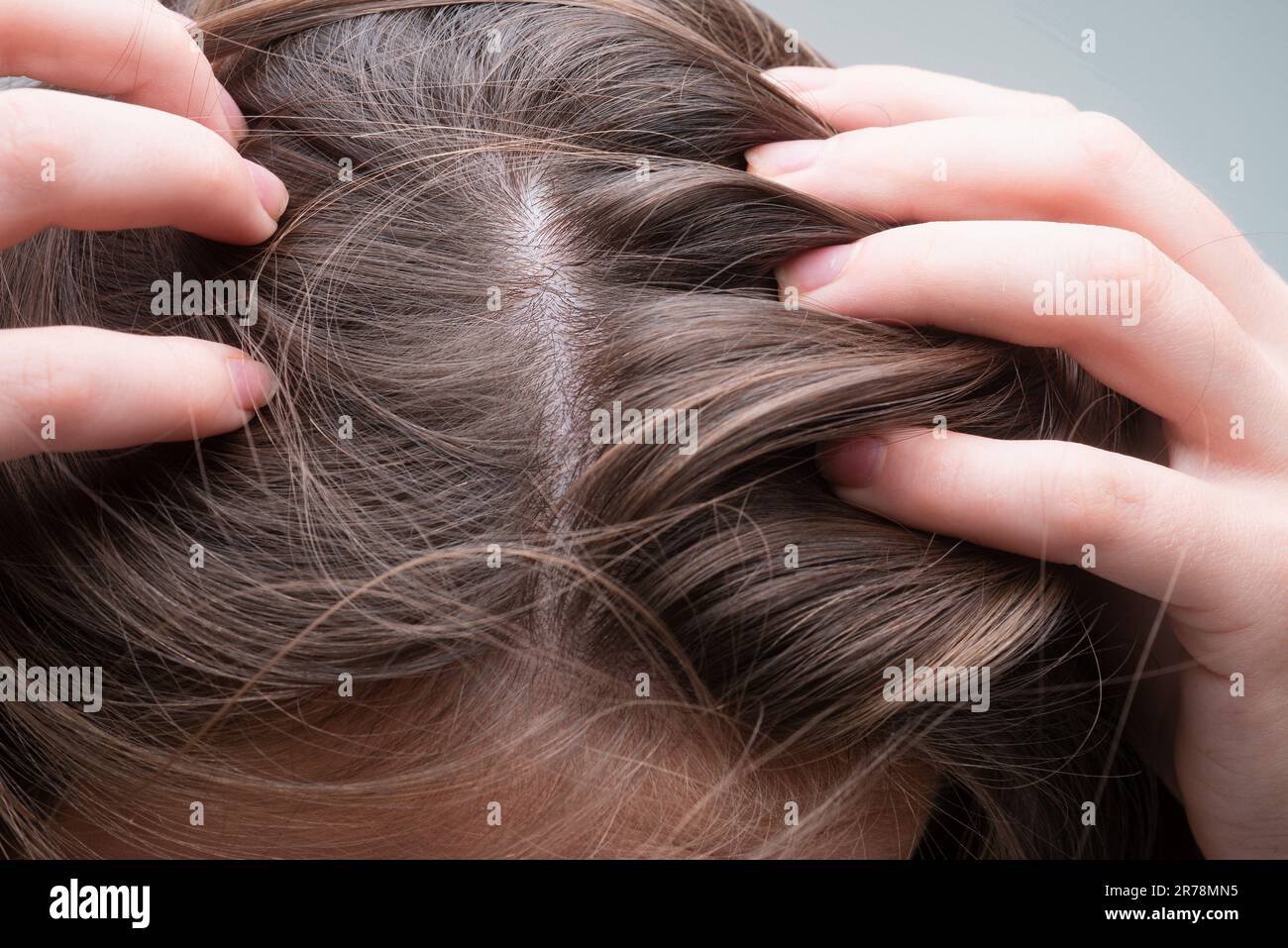 Close up of woman examining her scalp and hair, hair loss on hairline ...