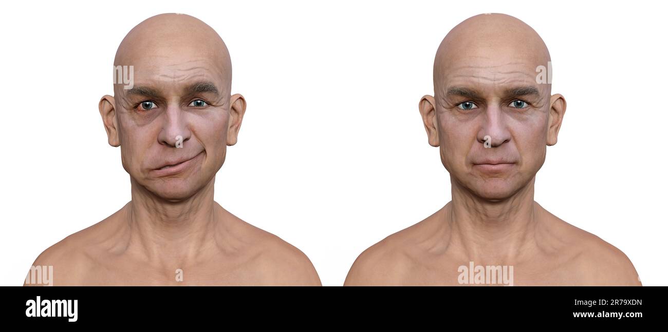 Facial palsy in a man and the same healthy man, photorealistic 3D ...