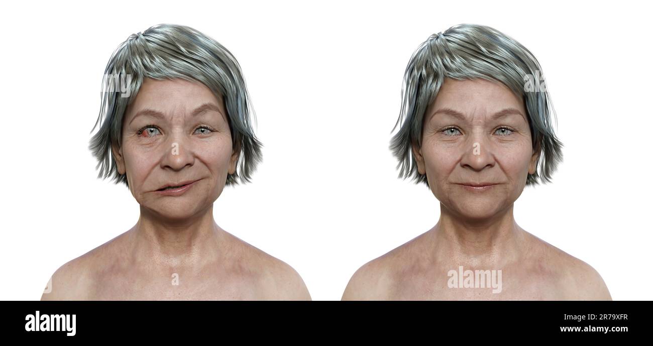 Facial palsy in a woman and the same healthy person, photorealistic 3D ...