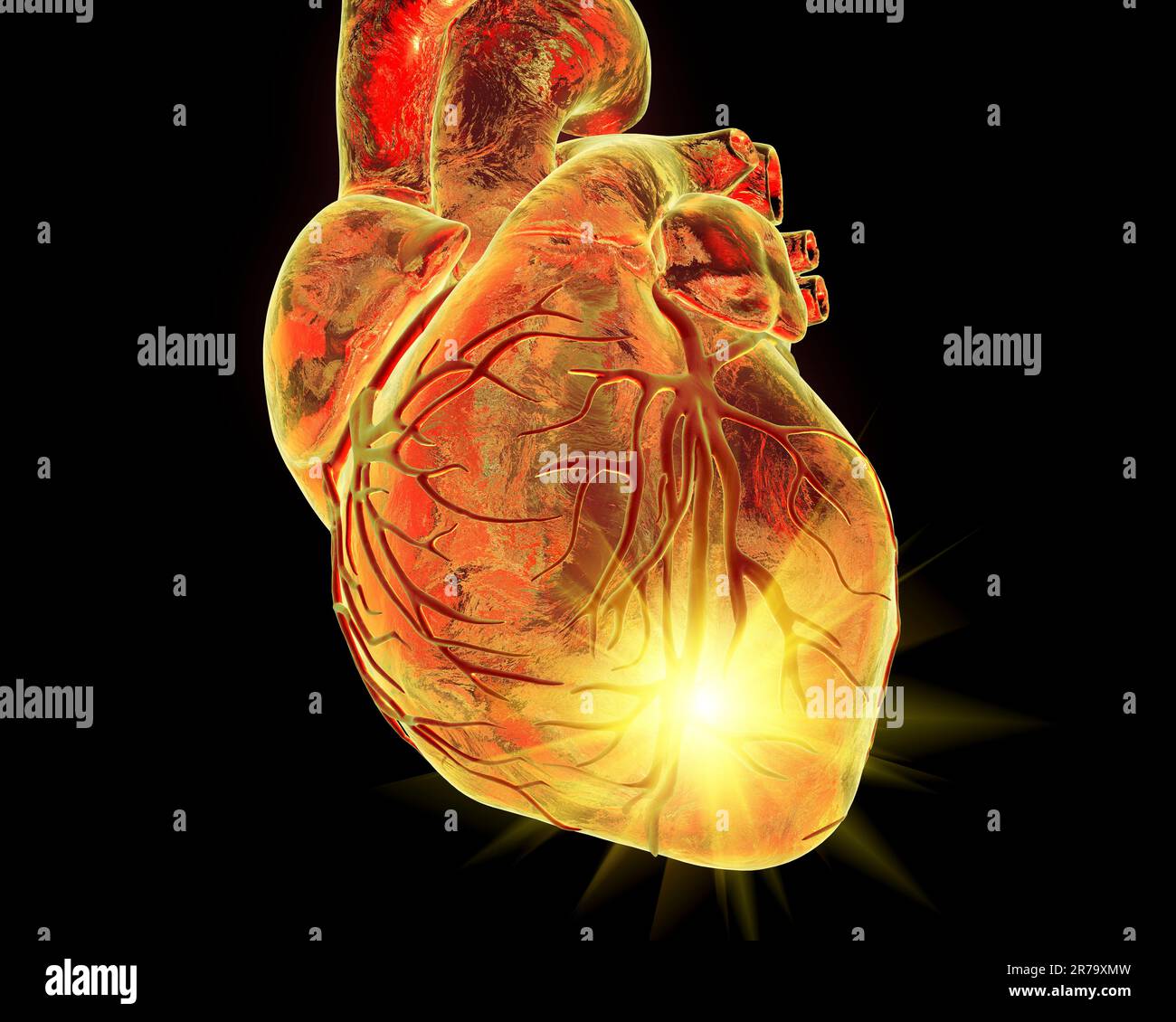 Heart attack, conceptual image for heart diseases. 3D illustration ...